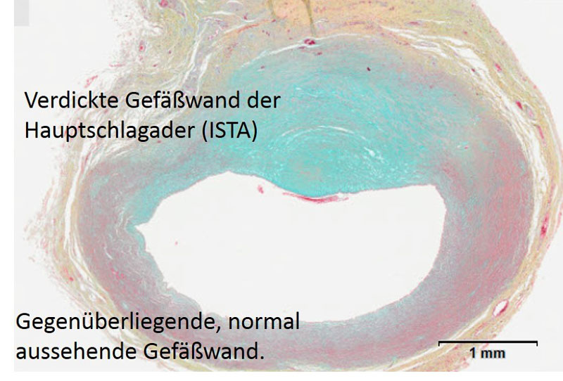 Verengte Hauptschlagader wird zur Lebensgefahr - Kinderherzen