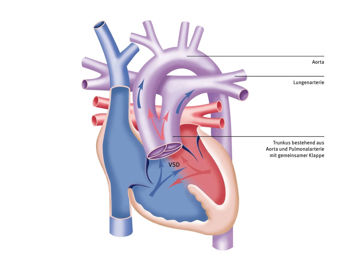 Truncus arteriosus communis (TAC) - Kinderherzen
